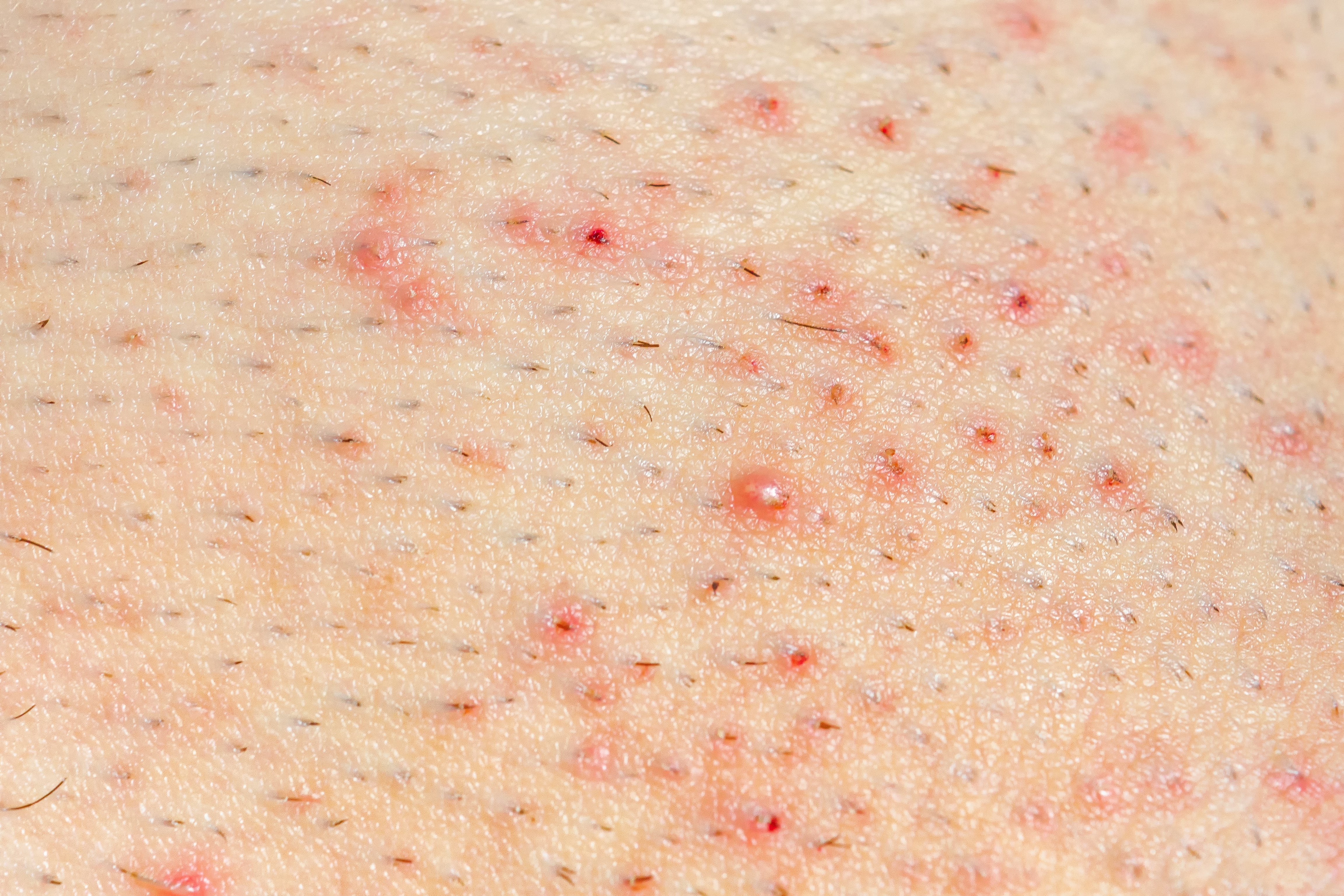 Say Goodbye to Ingrown Hairs: The Power of Exfoliating with a Mesh Spo ...